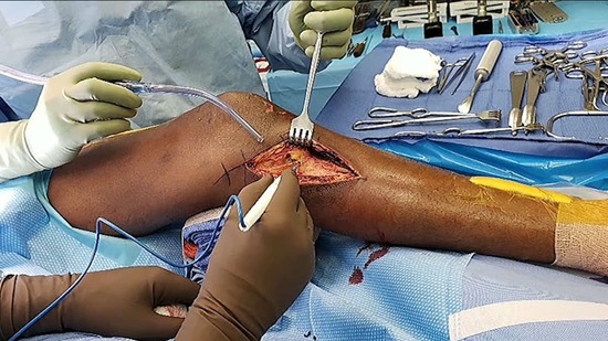 Approaching Fellowship: Tibial Plateau ORIF Approach Pearls ...