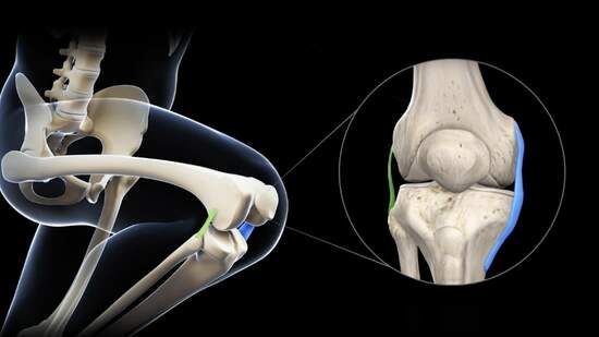 Medial (MCL) and Lateral (LCL) Collateral Ligament Tears: Overview ...