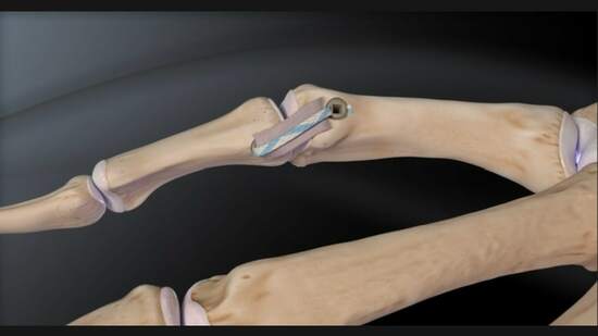 Thumb Sprains: Thumb UCL Repair Animation : OrthoPedia Patient