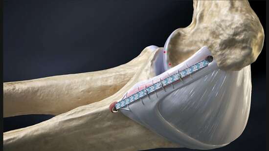 Ulnar Collateral Ligament (UCL) Injuries: Ligament Repair With Suture ...