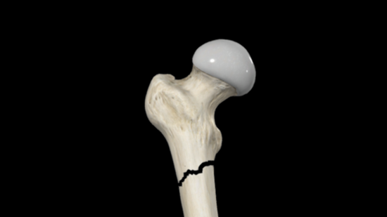 Subtrochanteric Fractures : OrthoPedia