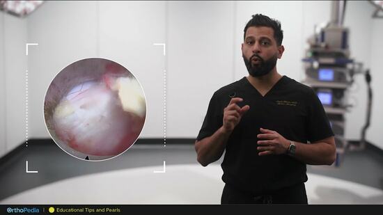 Dr. Hasan Demonstrates Tips and Pearls for Endoscopic Spine Surgery ...