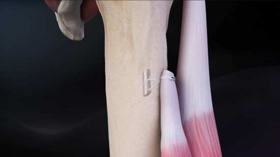 Biceps Tendinitis: Open Repair With Soft Anchors or Metal Buttons ...