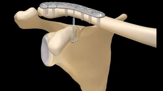 Collarbone Fractures (Clavicle Fractures): Open Reduction Internal ...