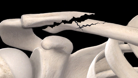 Collarbone Fractures (Clavicle Fractures) : OrthoPedia Patient