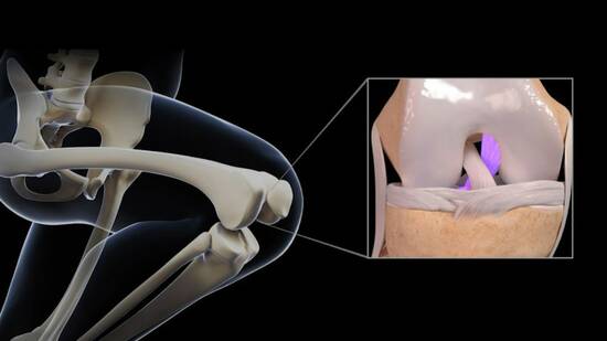 Posterior Cruciate Ligament (PCL) Tears: Overview : OrthoPedia Patient