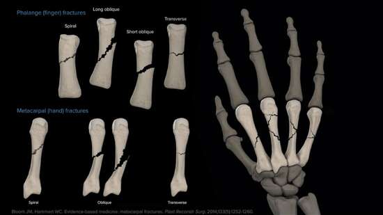 Hand and Finger Fractures: Treatment Options : OrthoPedia Patient