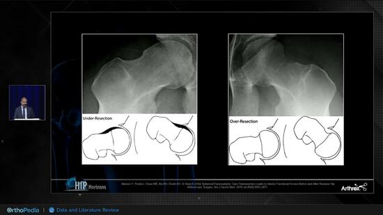 Femoroacetabular Impingement (FAI) and Labral Tears: Literature Update ...