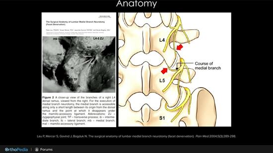 Spine Evolutions: Beginning Endoscopic Spine Surgery With Medial Branch ...