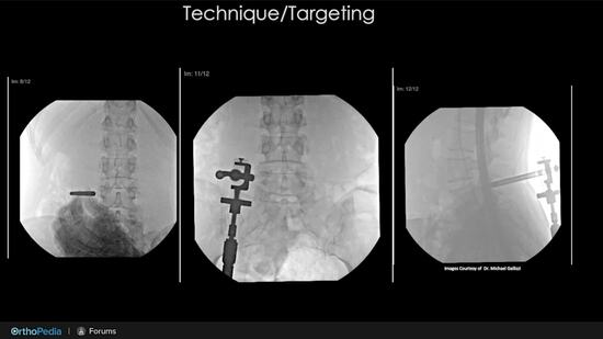 Endoscopic Approaches to Spine: Medial Branch Nerve Transection ...
