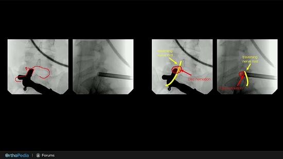 Endoscopic Approaches to Spine: Surgical Technique for Endoscopic ...