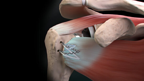 Shoulder Arthritis: Maintaining Shoulder Stability Following Shoulder ...