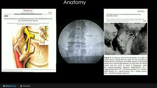 Endoscopic Approaches to Spine: Medial Branch Nerve Transection ...