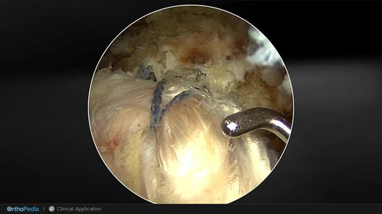 Proximal Hamstring Tears: Endoscopic Hamstring Repair Using a Knotless ...