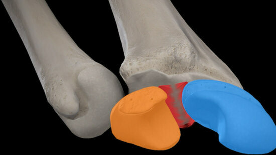 Wrist Instability (Scapholunate Ligament Injuries) : OrthoPedia Patient