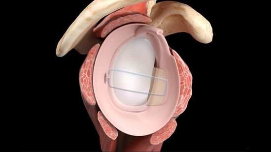 Shoulder Instability: Reconstruction of Bone Loss at Shoulder Socket ...