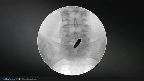 Disc Disease: Endoscopic Approach to Interlaminar Discectomy : OrthoPedia
