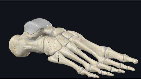 5th Metatarsal Fracture Foot