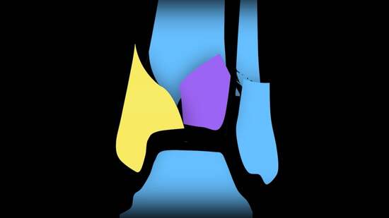 Pilon Fractures of the Ankle: Overview : OrthoPedia Patient