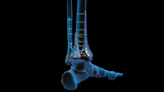 Pilon Fractures of the Ankle: Treatment Options : OrthoPedia Patient