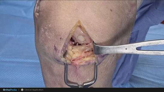 Osteochondral Lesions of the Knee: Autograft OATS® 2.0 Procedure : OrthoPedia