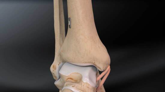 Chronic Ankle Sprains (Medial Ankle Instability): Deltoid Ligament ...