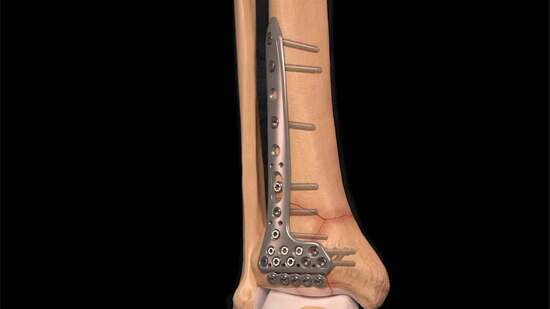 Pilon Fractures of the Ankle: Fixation With a Plate and Screws ...