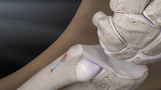 Triangular Fibrocartilage Complex Tfcc Tears Ulnar Tunnel Foveal