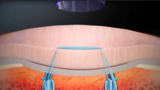 Shoulder Instability: Bony Defect Repair With Soft Tissue Animation ...