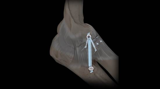 Elbow Lateral Collateral Ligament Injuries: Treatment Options ...