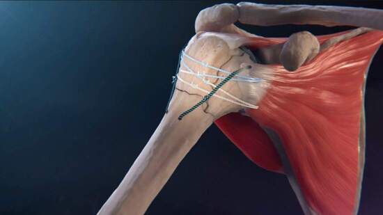 Upper Arm Bone Fractures (Proximal Humerus Fractures): Reverse Total ...
