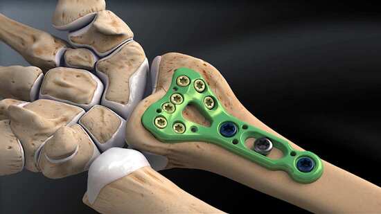 Wrist Fractures: Distal Radius Fracture Repair With a Volar Plate ...