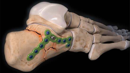 Heel Bone Fractures (Calcaneus Fractures): Repair With a Plate and ...