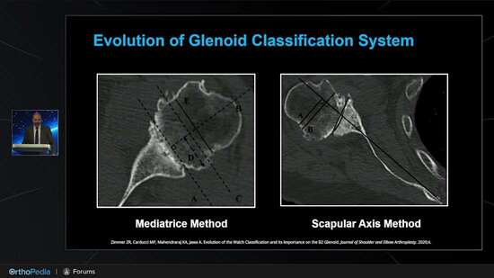 Measurements and Angles in Reverse Total Shoulder Arthroplasty : OrthoPedia