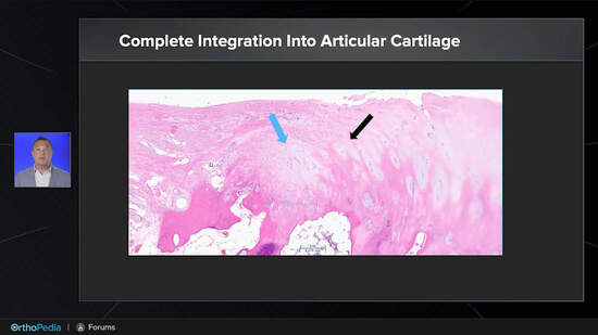 Rotator Cuff Tears: Histologic Evaluation of Acellular Dermal Allograft ...