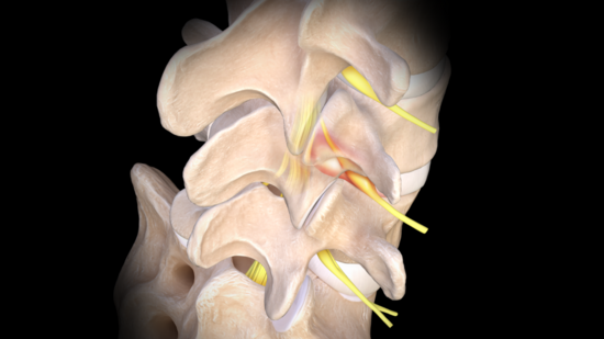Nerve Entrapment : OrthoPedia
