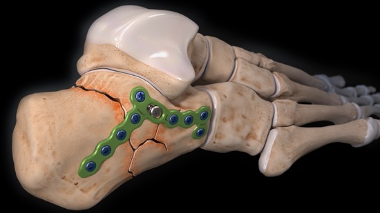 Heel Bone Fractures (Calcaneus Fractures) : OrthoPedia Patient