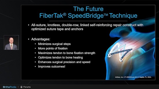 OTIF: My SpeedBridge™ Technique Journey : OrthoPedia