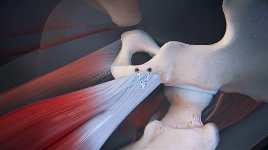 Hip Hamstring Tears: Hamstring Tendon Repair With Anchors Animation ...