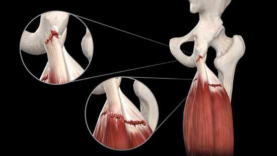 Hip Hamstring Tears: Treatment Options : OrthoPedia Patient