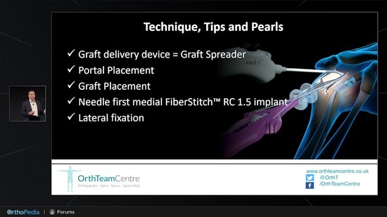 CuffMend™ Technique in Rotator Cuff Augmentation : OrthoPedia