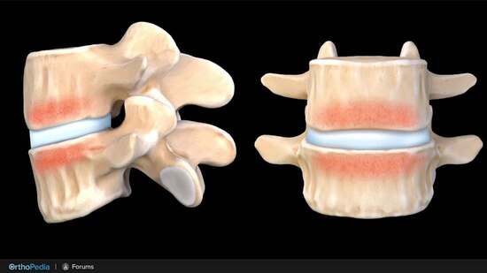 Spine Evolutions: IntraOsseous BioPlasty® (IOBP®) Procedure for Modic ...