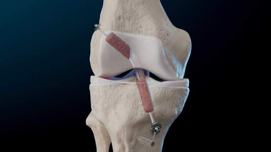 Anterior Cruciate Ligament (ACL) Tears: ACL Reconstruction With ...