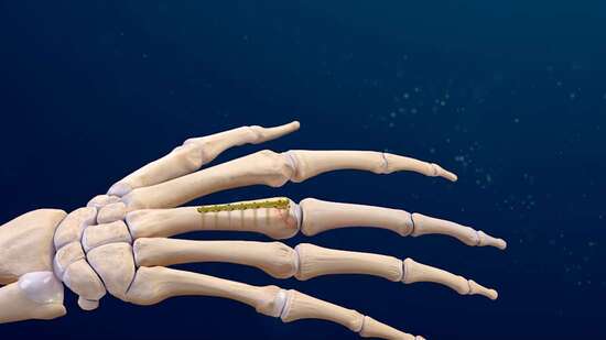 Hand and Finger Fractures: Repair With a Plate and Screws Animation ...