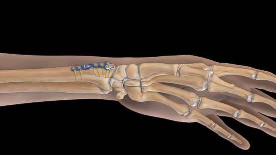 Wrist Fractures: Fixation of Radial Styloid Process Fractures With a ...