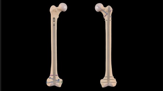 Thigh Bone Fractures: Repair With a Bone Nail and Screws Animation ...