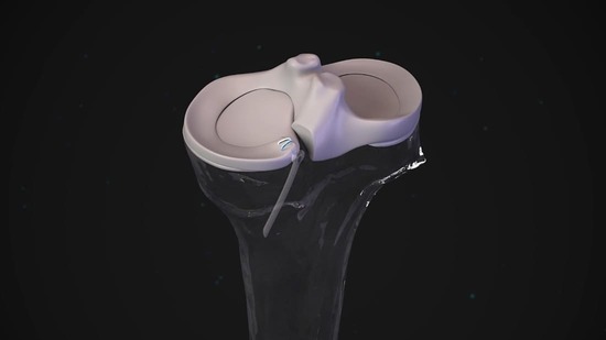 Meniscus Tears: Meniscal Root Repair Animation : OrthoPedia Patient
