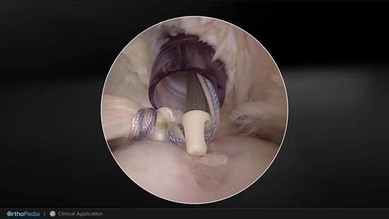 Proximal Biceps Tendinopathies: Top-of-the-Groove Loop ‘N’ Tack™ Biceps ...