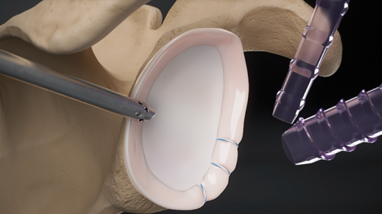 Inestabilidad del Hombro: Animación sobre la Reparación Labral ...