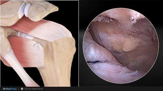 Subscapularis Tendon Tears: Upper-Border Subscapularis Repair Using the ...